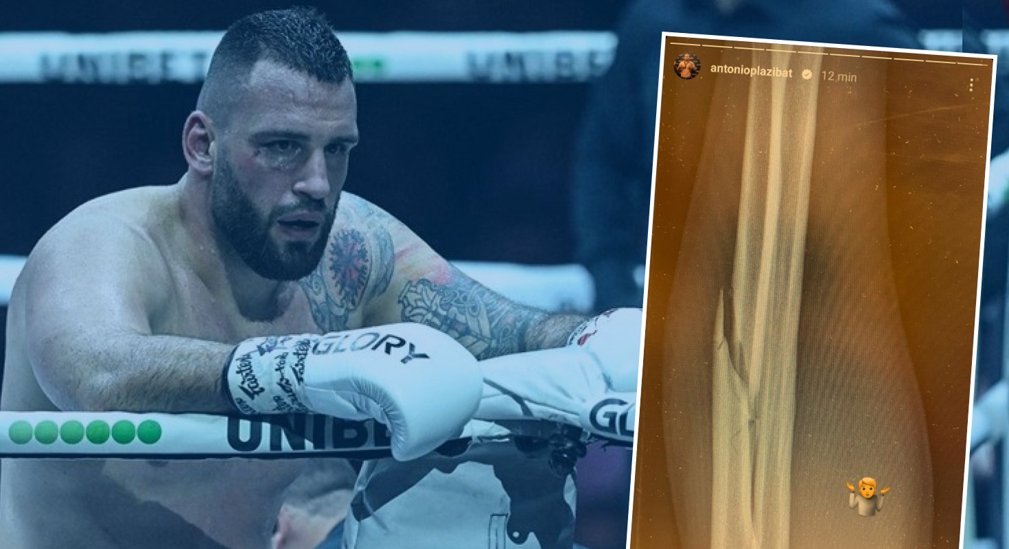 Plazibat objavio rendgen slomljene ruke. S ovakvim lomom se borio još ...